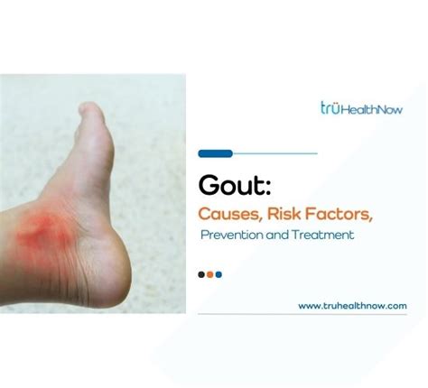 Gout Causes Risk Factors Prevention Treatment Tr Healthnow