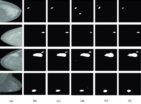 Segmentation Results Of Four Samples On Inbreast Dataset From Left To Download Scientific
