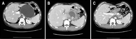 An Example Of Successful Pseudocystic Drainage A A 10 8 Cm Download Scientific Diagram