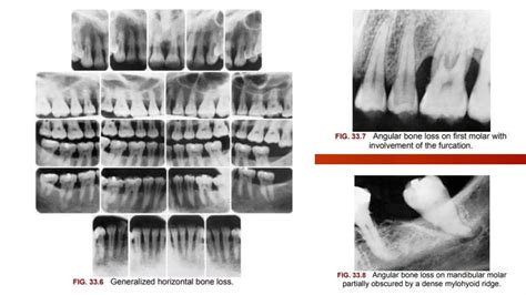 Radiographic Examinations Of Bone Loss And Pattern Of Bone Loss Pptx