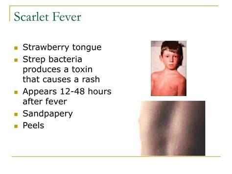 Ppt Unit 4 Part 3 Streptococcal Serology Powerpoint Presentation