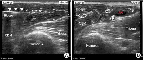 Figure 1 From Ultrasound Guided Axillary Brachial Plexus Block Performed By Oirthopedic Surgeon