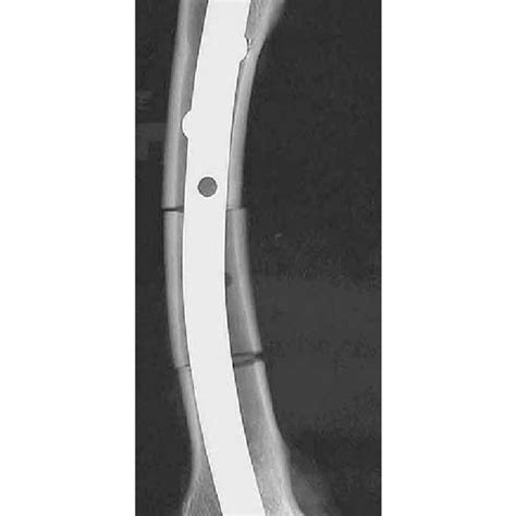 A Direct Postoperative Radiograph Shows A Segmental Defect Which Is Download Scientific
