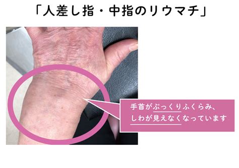 写真で分かるリウマチ集 ～手のリウマチ～ さとう埼玉リウマチクリニック《大宮院》｜さいたま市のリウマチ専門のクリニック