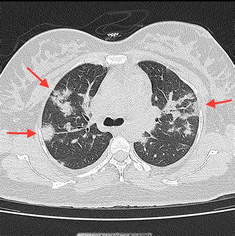 Ground Glass Opacity At Callum Melvin Blog