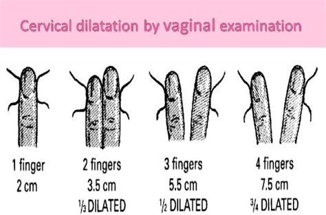 Dilation Chart Midwifery Notes Dialation Chart