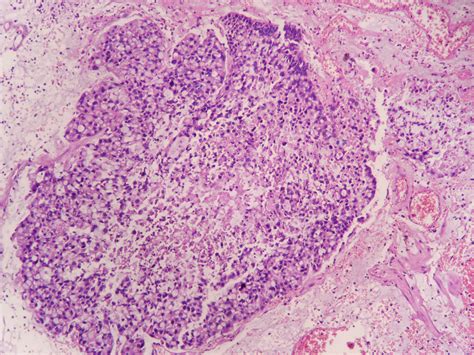 Mucinous Adenocarcinoma Of Cervix Histopathologyguru