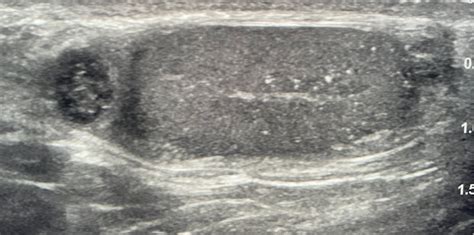 Torsed Testicular Appendix R Radiology