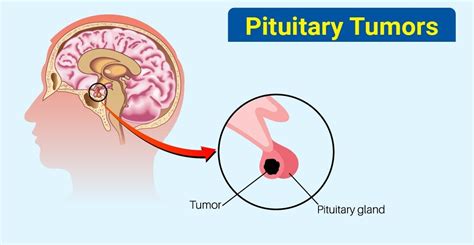 What Is A Pituitary Tumor Symptoms And Treatment