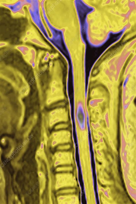 Multiple Sclerosis Mri Stock Image C0584682 Science Photo Library