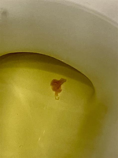 Fleshy Piece Of Tissue Discharge Every Time With Urination Rmedical