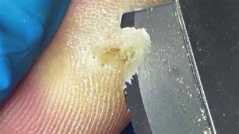 Pedicure Tutorial Trim Thick Calluses Quickly Magicknife YouTube