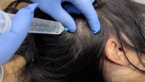Inflations Of Scalp Tissue Expanders In Two Stage Skull Augmentations