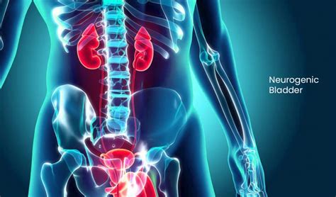 Neurogenic Bladder Neuromodulation Center