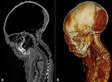 Sagittal Multi Planar Reformation A And Sagittal Volume Rendering