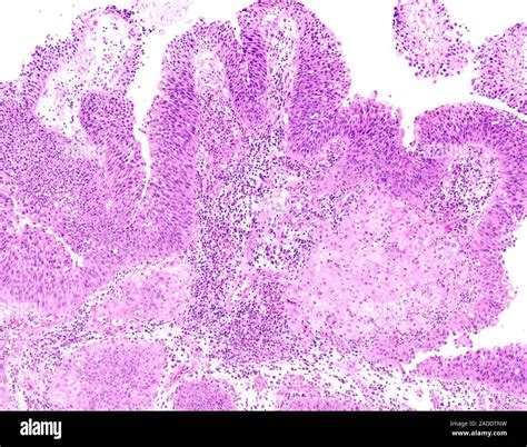 Light Micrograph Of Invasive High Grade Papillary Urothelial Carcinoma Also Known As Papillary