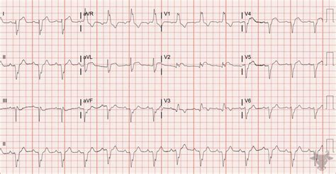 Bifascicular Block Ecg Stampede
