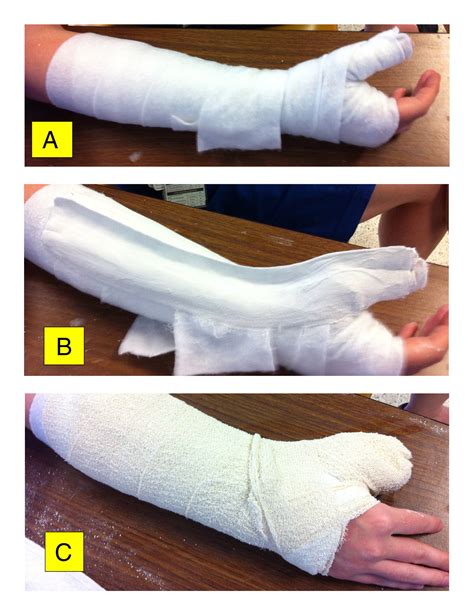 Application Techniques For Plaster Of Paris Back Slab Resting Splint