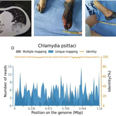 A Chest Computed Tomography Ct Revealed Diffuse Bilateral And