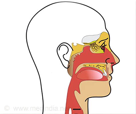 Laryngitis Diagram