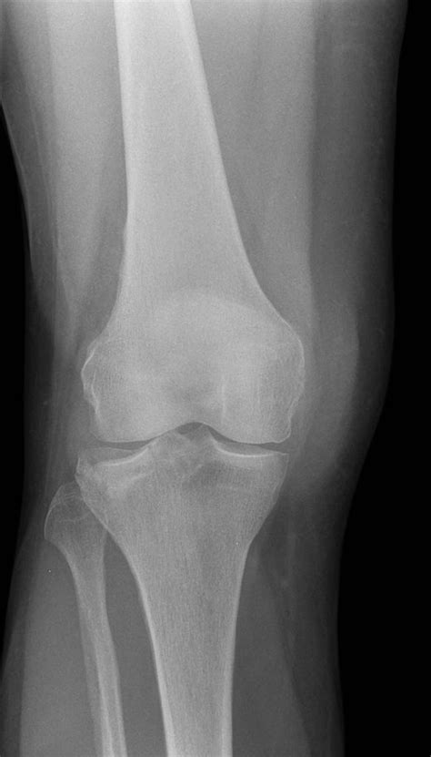 Tibial Condyle Fracture