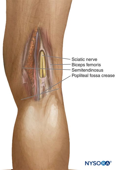 Popliteal Block