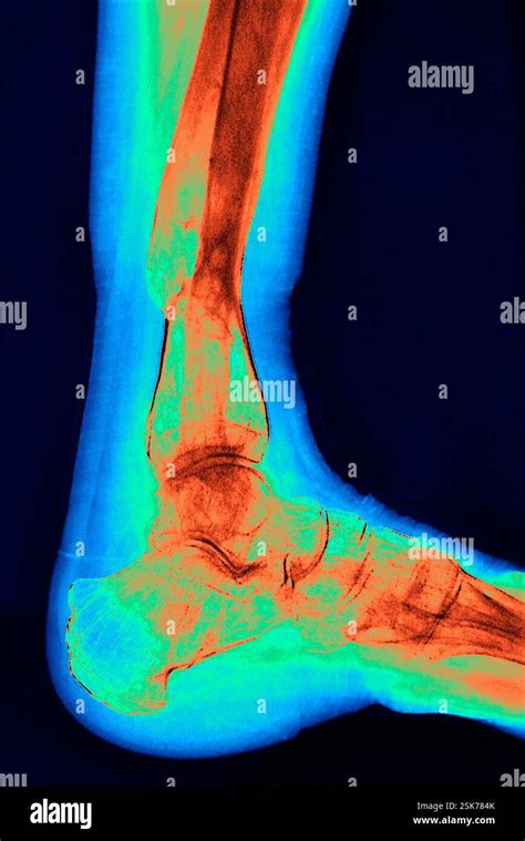 Coloured X Ray Side View Of The Ankle Of A Patient Aged 70 Showing