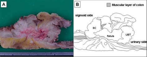Cross Section Of The Resected Specimen A Macroscopic Picture Of A Download Scientific Diagram