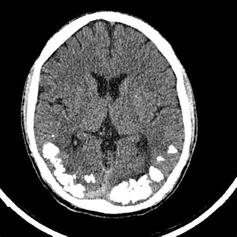 Mosaic Pattern And Flattening Of A Duodenal Bulb Seen On Upper