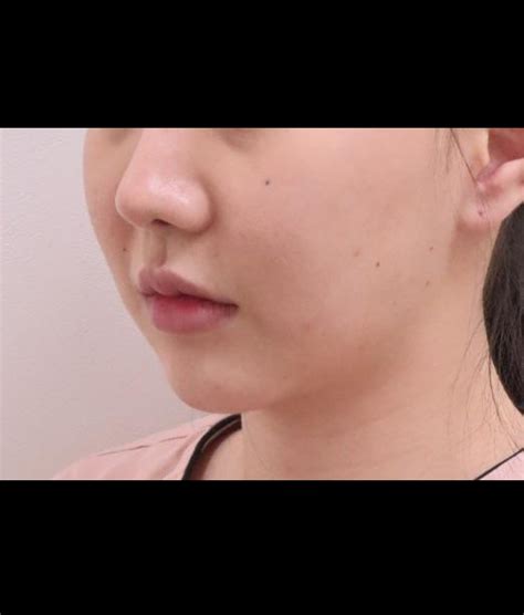 파워v얼굴지방흡입 V핏리프팅 후기 닥터정 리반의원 파워v얼굴지방흡입 V핏리프팅 후기 닥터정 리반의원