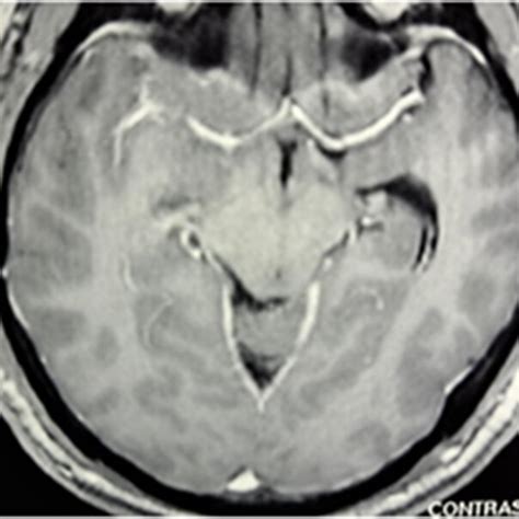 Contrast Enhanced Brain Mri In A 53 Year Old Man Showing A Large Cystic Download Scientific