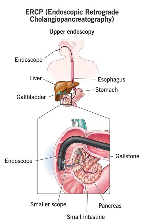 Ercp Stone Removal And Stenting Gastroworld Clinic Health Treatment Ercp Stone Removal And Stenting Gastroworld Clinic Health Treatment