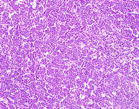 Sheets Of Atypical Medium Sized Monomorphic Lymphocytes With Frequent Download Scientific