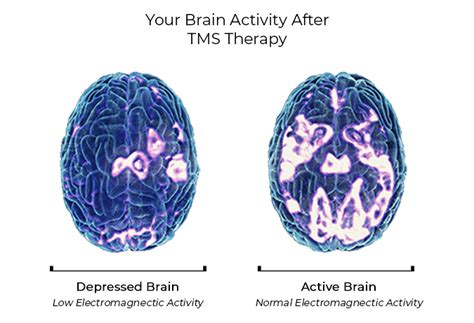 TMS Therapy Treatment In Florida Comprehensive Care Clinic