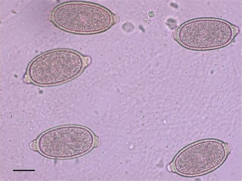 Capillaria Egg Vs Trichuris Egg