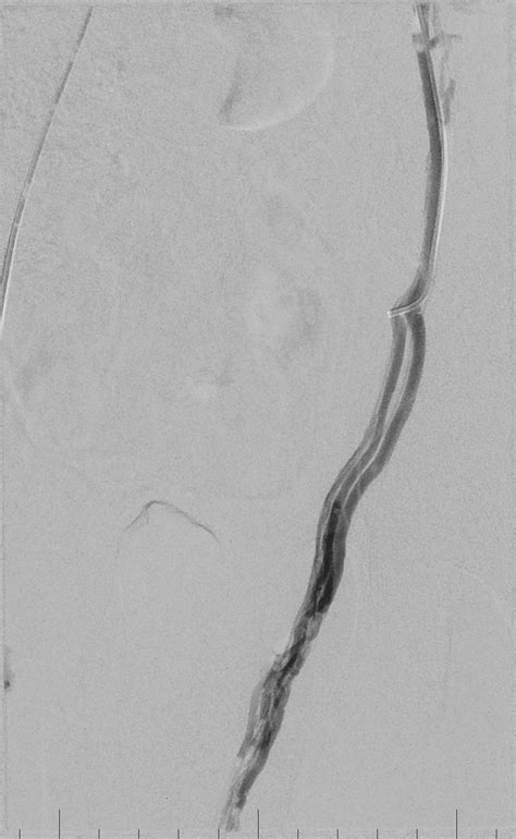 Interventional Radiology Radiology Sa