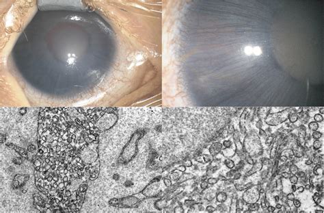 Case 1 A B Anterior Segment Od Of Patient 1 Showing A Diffusely Download Scientific Diagram