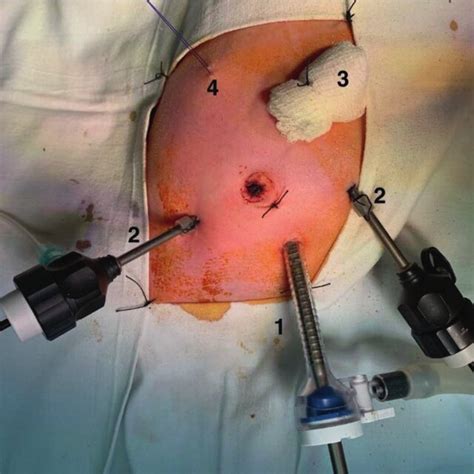 Pdf Duodenal Atresia