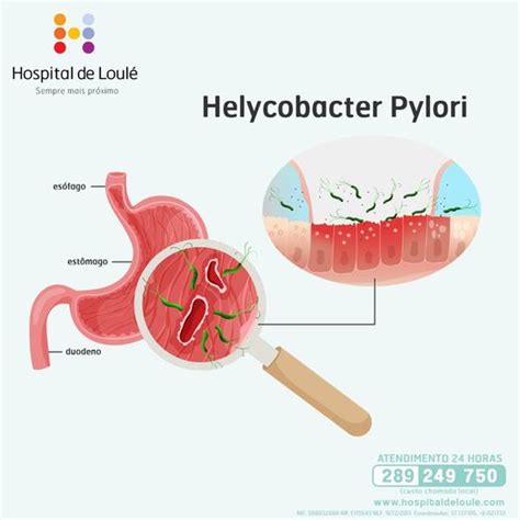 Have You Ever Heard Of Helycobacter Pylori Hospital De Loulé