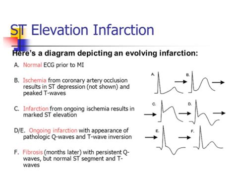 Inflammation Ischemia And Infarction Flashcards Quizlet