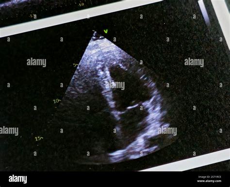 Echocardiography Or Cardiac Ultrasound Shows Normal Values Except For Left Ventricular