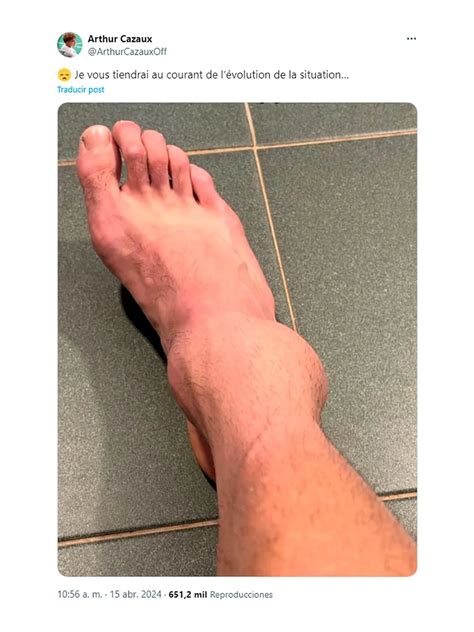 La Terrible Lesi N De Un Tenista Que Dio La Vuelta Al Mundo La Foto De Su Tobillo Que Hizo