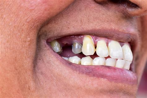 Single Tooth Removable Partial Denture
