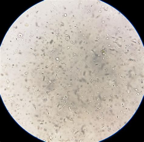 Semen Analysis Under Microscopy Showing Pyospermia Or Leukocytospermia Sperm Analysis