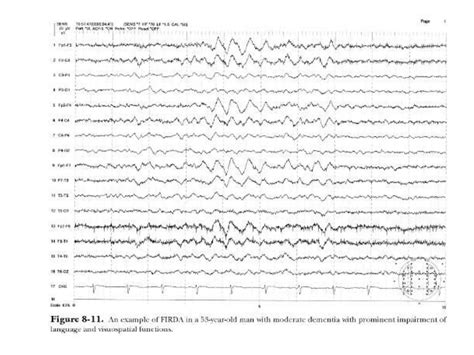 Recognition Of Abnormal Eeg Pptx Brain And Nervous System