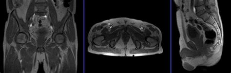 Mri Proctogram Planning Mri Proctogram Protocols Indications For Mri Proctogram Scan