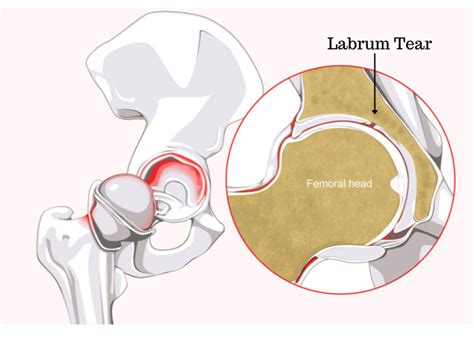 Hip Labrum Tear Orthopedic Hip Specialist Sugar Land Pearland Houston TX