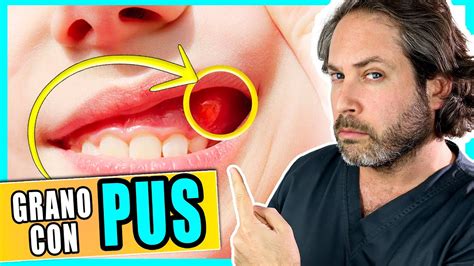 Bulto En La Encía Con Pus Causas Síntomas Y Tratamiento Recomendado