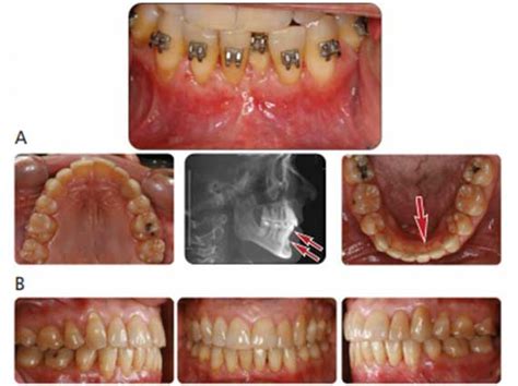 Exploring The Orthodontic Periodontic Relationship Decisions In Dentistry