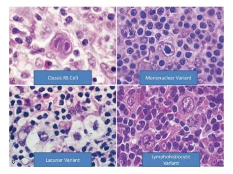Infectious Mononucleosis Pathology